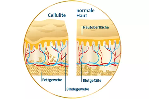 Bindegewebsschwäche: Wie Sie Ihr Bindegewebe stärken
